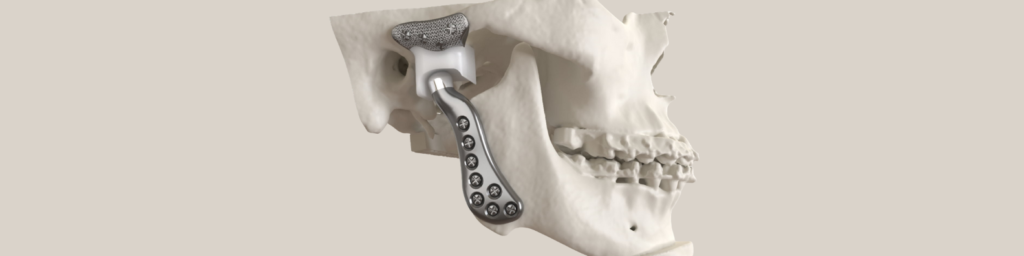 TMJ (Temporomandibular Joint) Surgery - Dr Priyadarshini Banerjee